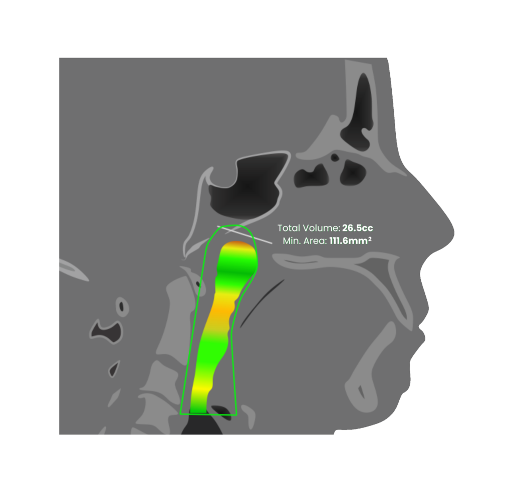 Sleep Apnea Treatment | Vivos Therapy | Midtown Dental Clinic
