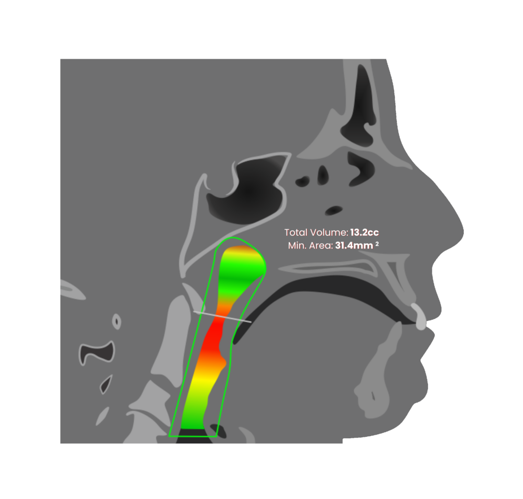 Sleep Apnea Treatment | Vivos Therapy | Midtown Dental Clinic